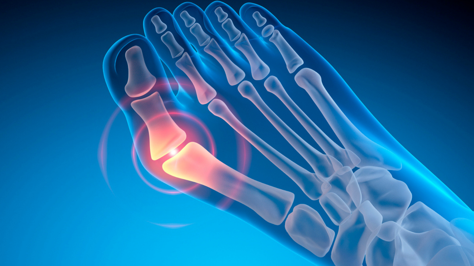 Bunions Treatment - True Physio